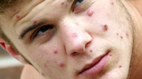 NTV Kenya: Kenya is not worried about monkeypox: Expert