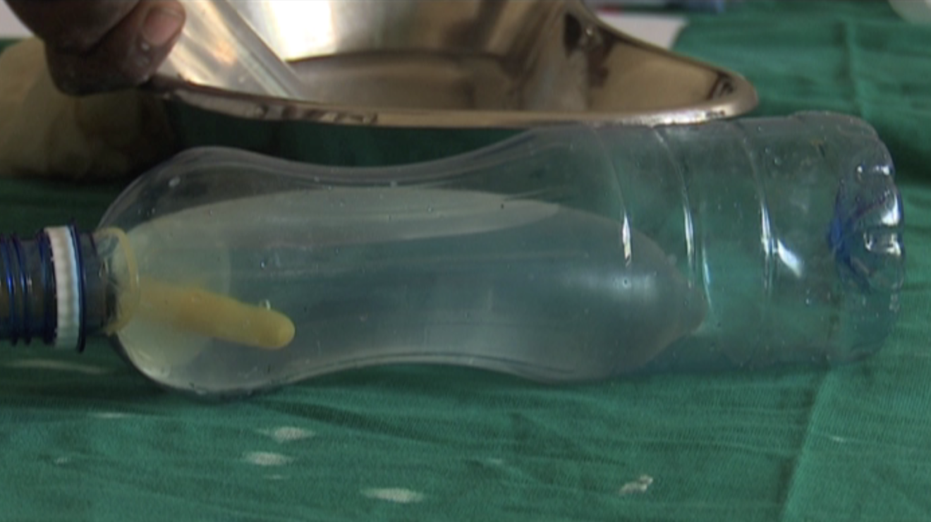 NTV Kenya: Life-saving uterine balloon reducing maternal deaths