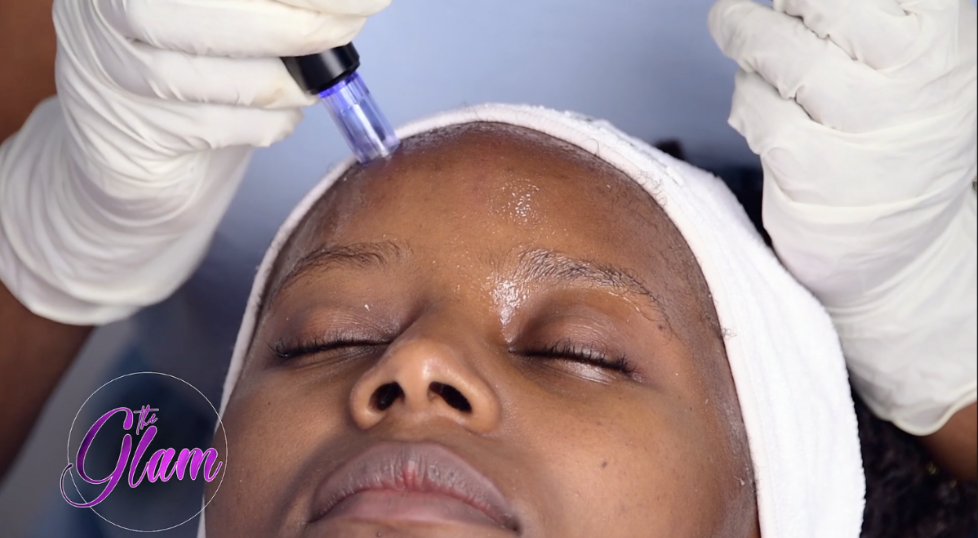 NTV Kenya: “Micro-needling: A Minimally Invasive Procedure for Skin ...