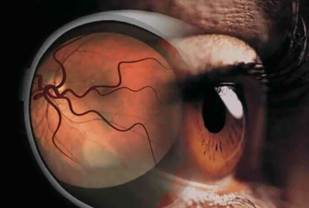NTV Kenya: Shedding Light on Diabetic Retinopathy: A Journey of ...